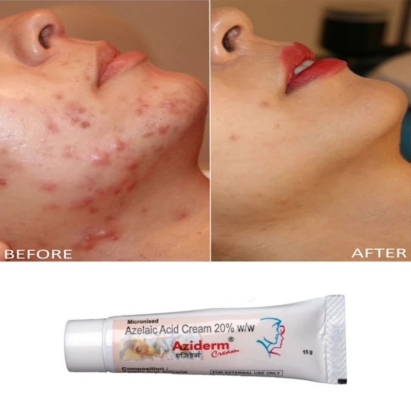 Ácido azelaico 20% blanqueamiento eliminar las manchas oscuras rosácea ...